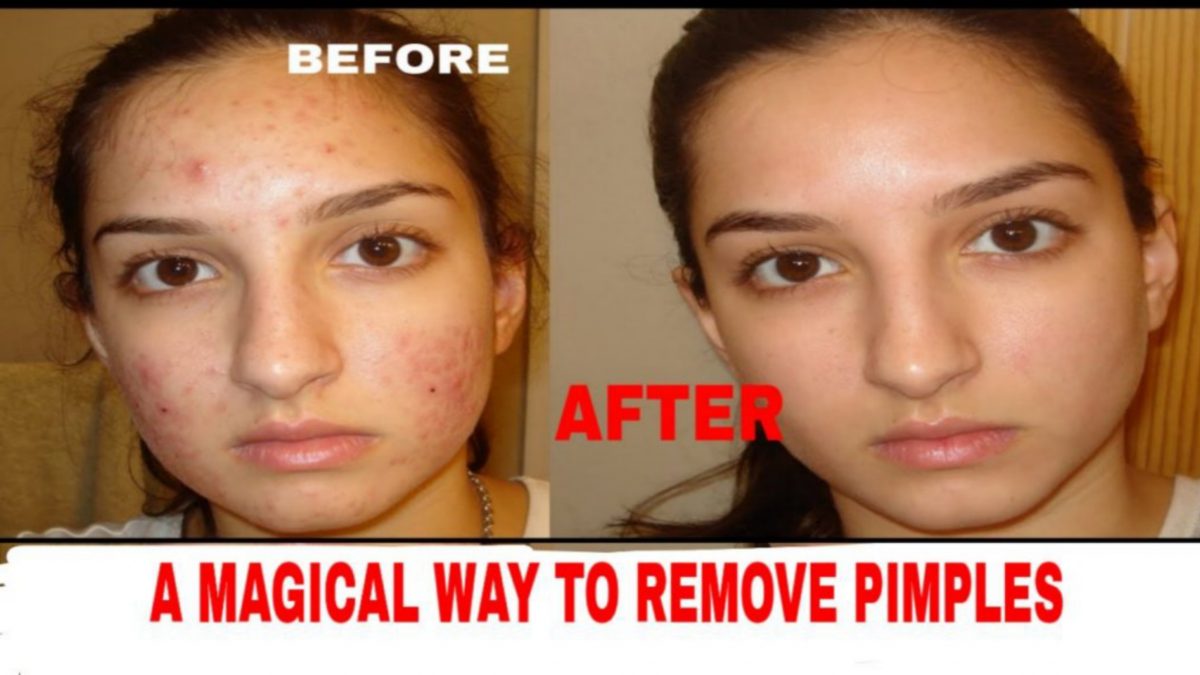 A Magical Way To Remove Pimples » 365 Reporter